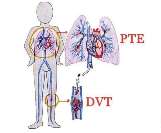 智慧化管理 高效防治住院患者VTE_进行_栓塞_血栓