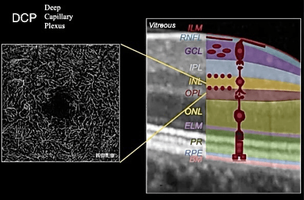 OCTA报告解读 | 教你层层分析⥤识病变_血管_血流_视网膜