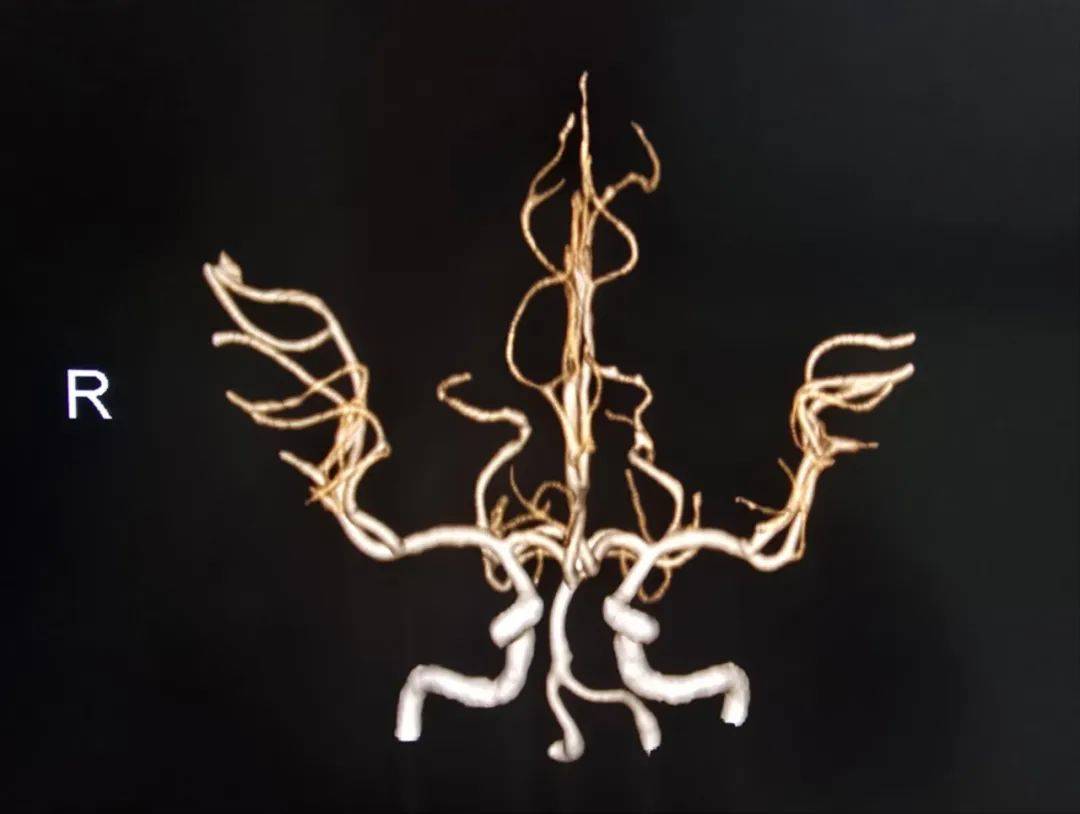 【健康医声】CTA、MRA、DSA分不清楚， 一文带你搞懂三种关于"A”的检查_血管_成像_优缺点