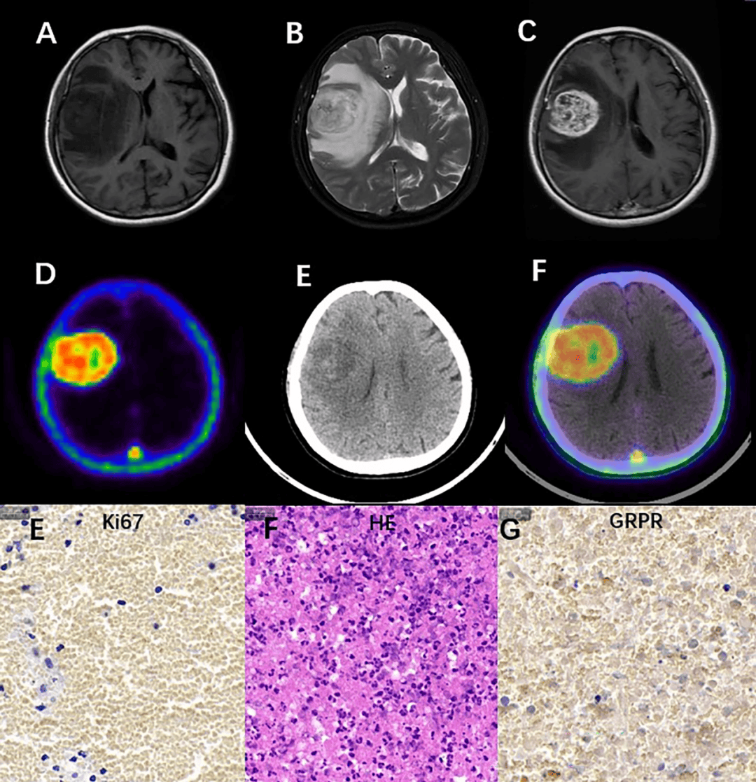 学术动态 | 北京协和神外等团队首次证实在脑胶质瘤诊断中应用68Ga-NOTA-RM26PET/CT的价值_肿瘤_染色_SUVmax
