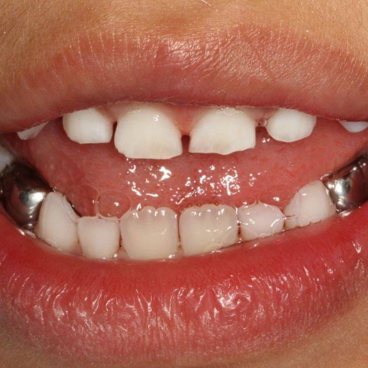 6.1 特辑｜PMTC，这个六一，送孩子特别的“隐形铠甲”_牙齿_护理_儿童